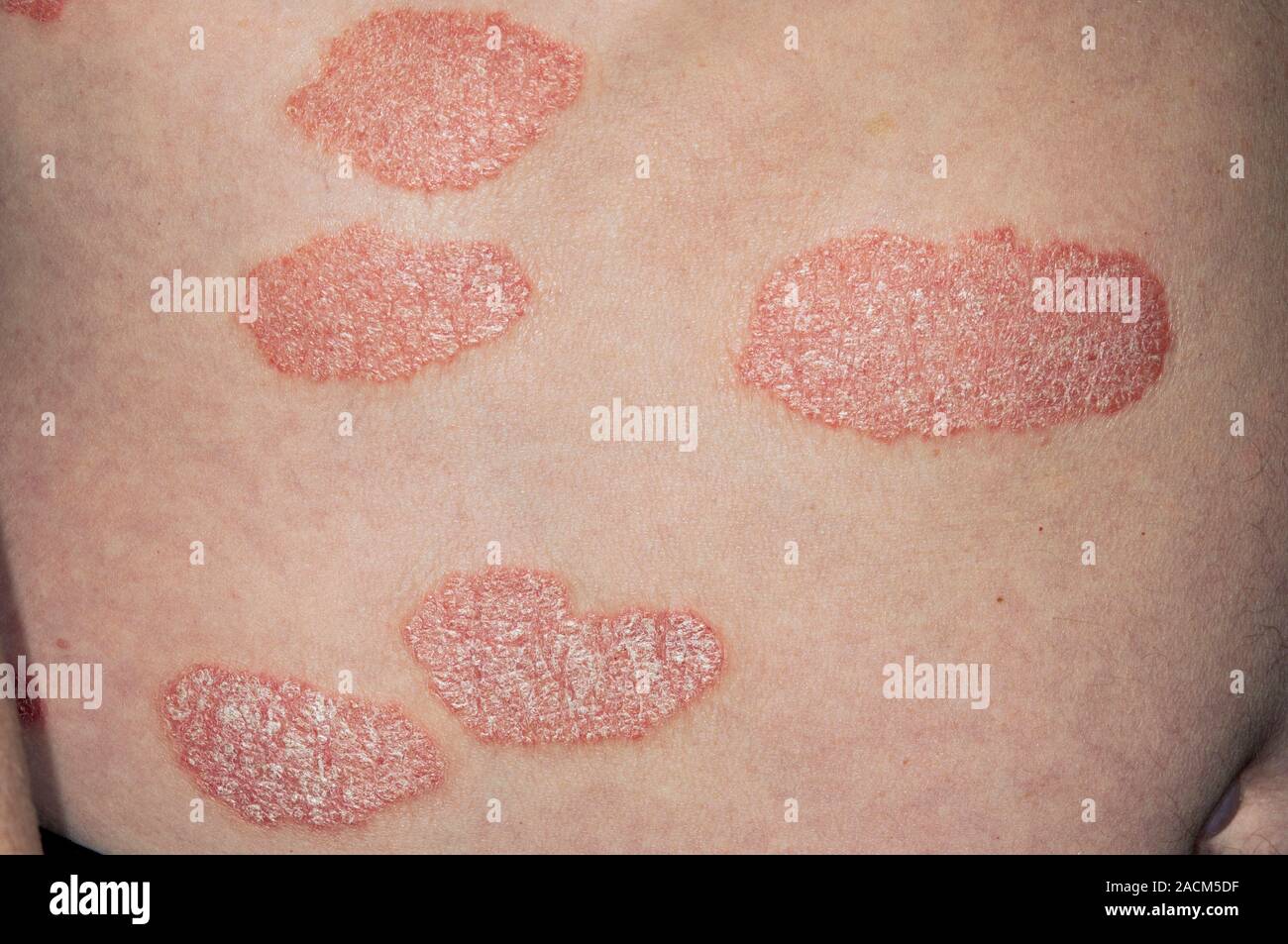 Plaque psoriasis on the skin of the back in a 55 year old male patient ...