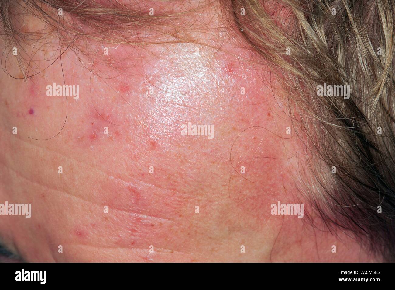 Superficial burns to the skin of the forehead in a 60 year old male ...