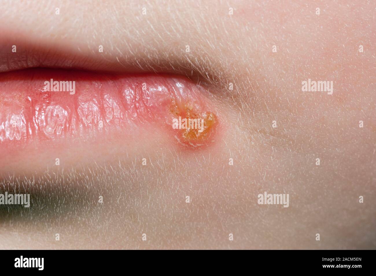 Close-up of a cold sore on the lower lip in a 6 year old female patient ...