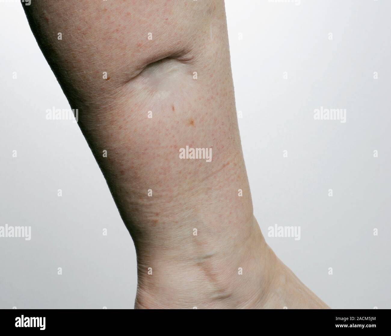 Not for use in Television Not for use in Television Scar on the shin of ...