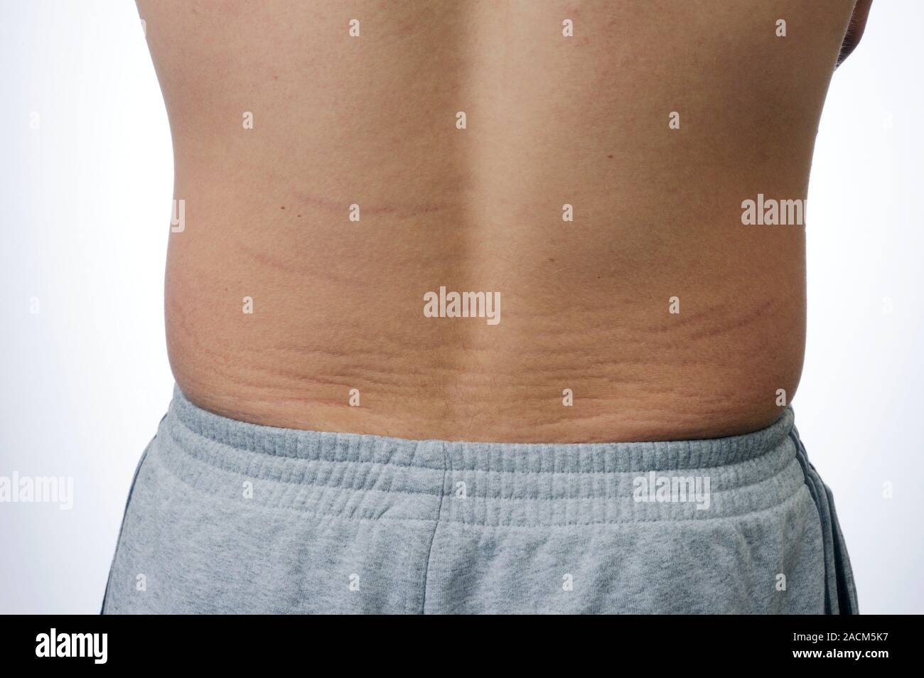 Not for use in Television Not for use in Television Skin striae (lines ...