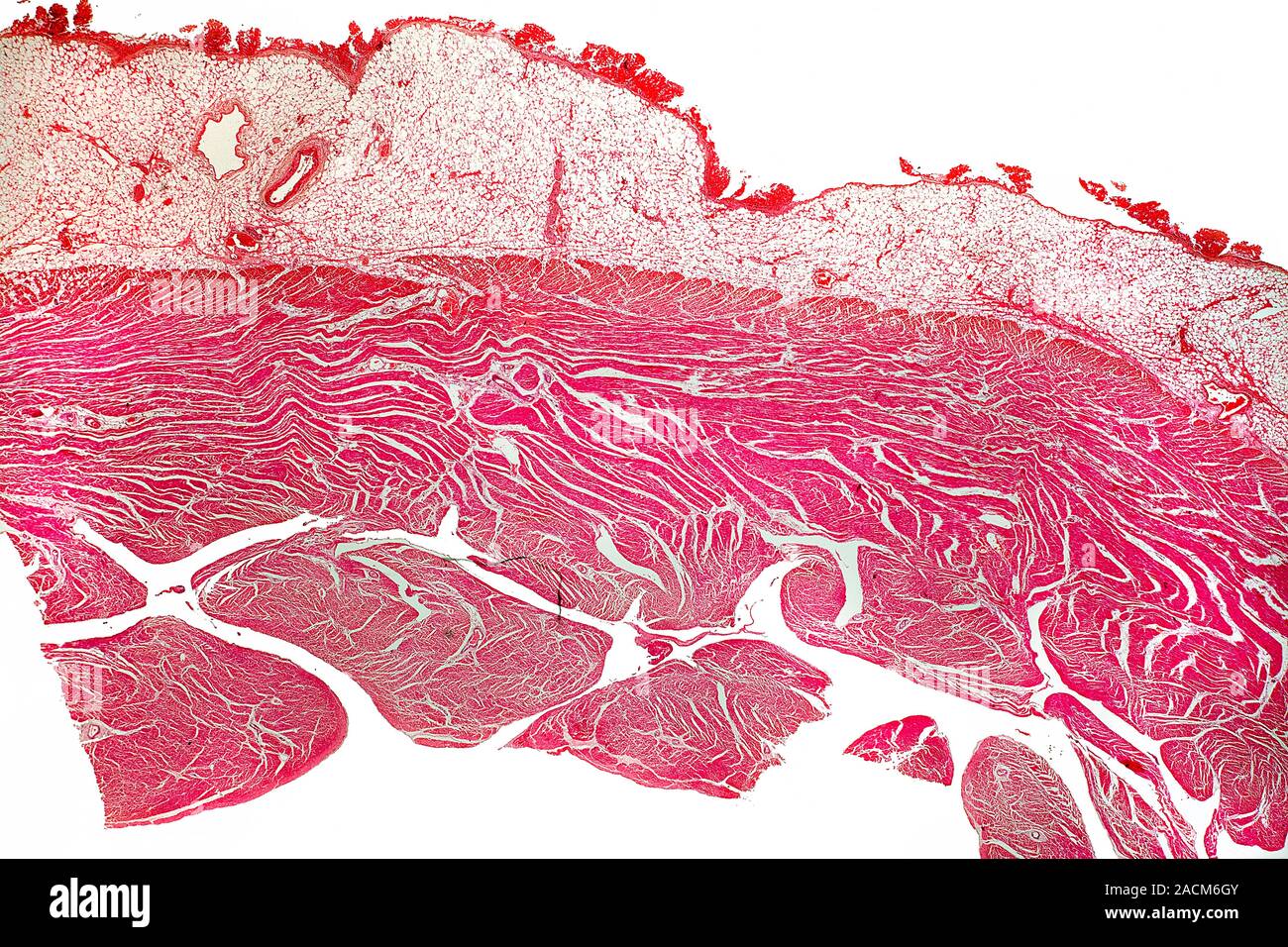 Pericarditis. Light micrograph of a section through the heart and its ...