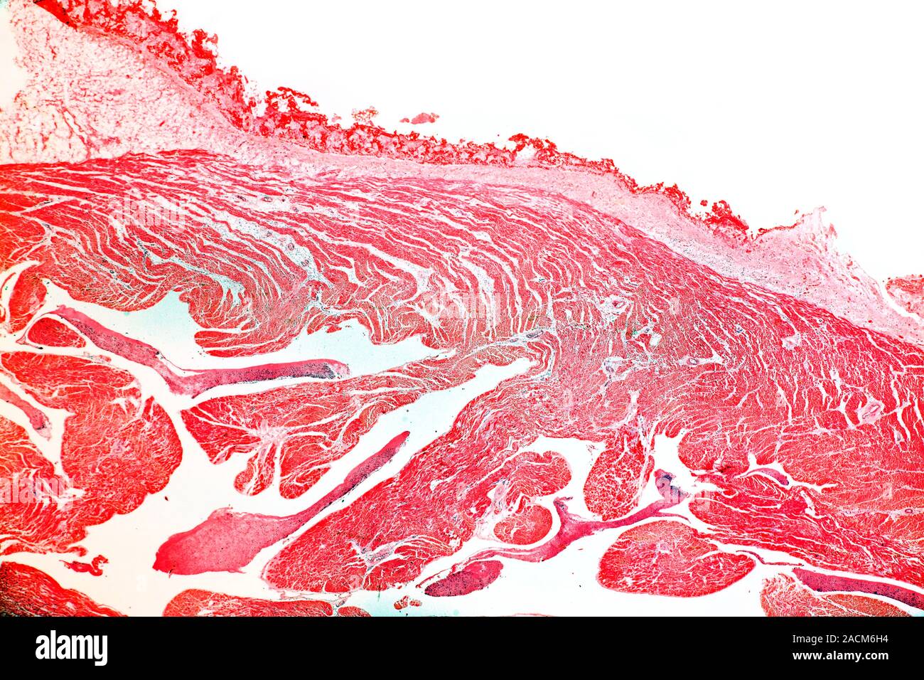 Pericarditis. Light micrograph of a section through the heart and its ...