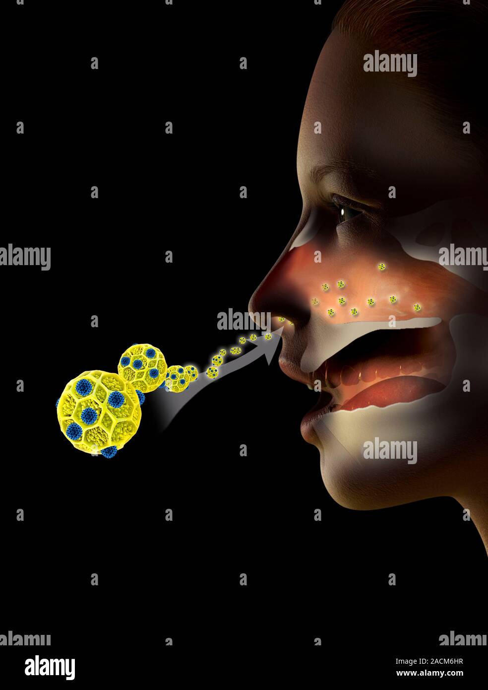 Hay fever. Artwork depicting hay fever showing pollen grains (yellow ...