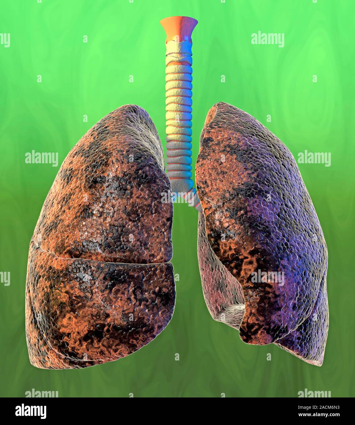 Smoker's lungs. Computer artwork of lungs damaged through smoking. At ...