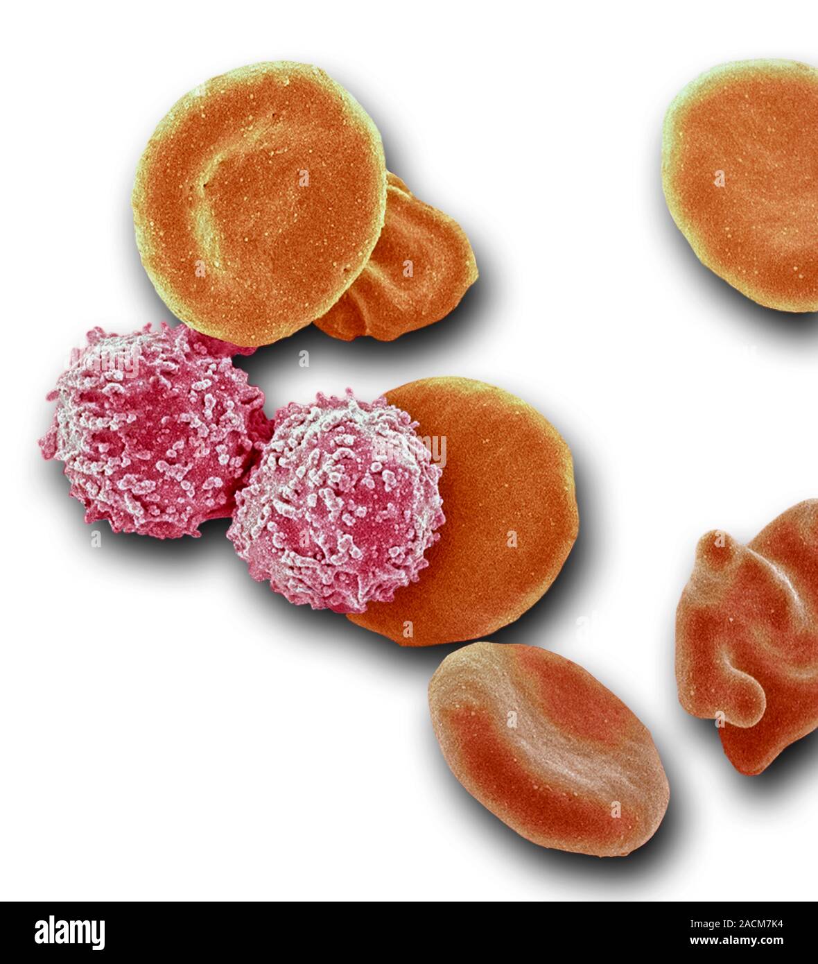 Leukaemia blood cells. Coloured scanning electron micrograph (SEM) of ...