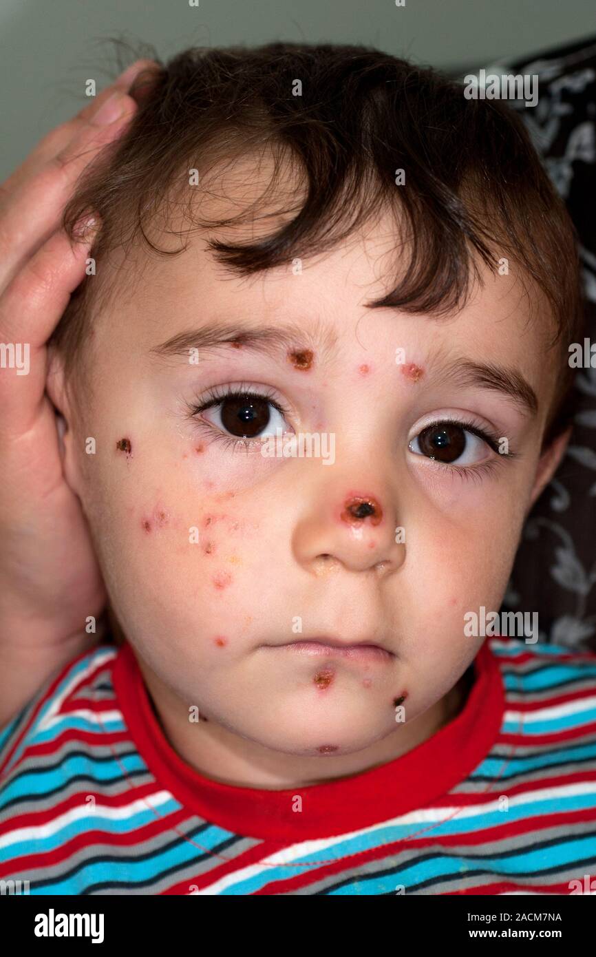 Scabbed pustules (sores) on the face of a 3 year old boy due to ...
