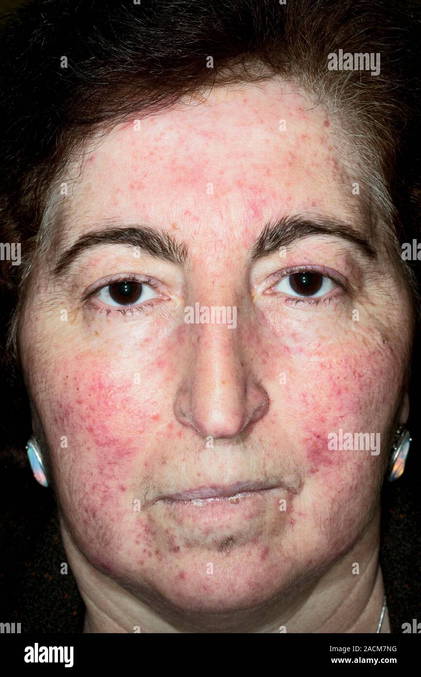 Acne rosacea on the skin of the face in a 60 year old female patient ...