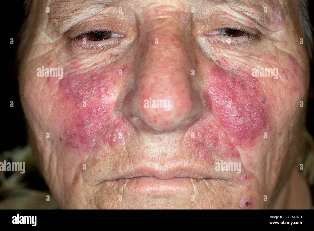 Acne rosacea on the skin of the face in a 73 year old female patient ...