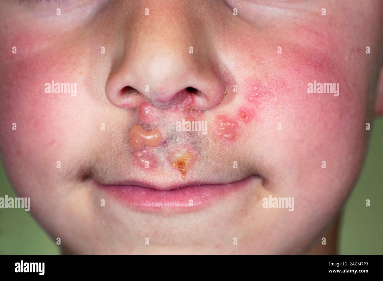 Pustules (sores) on the face of a 9 year old male patient due to ...