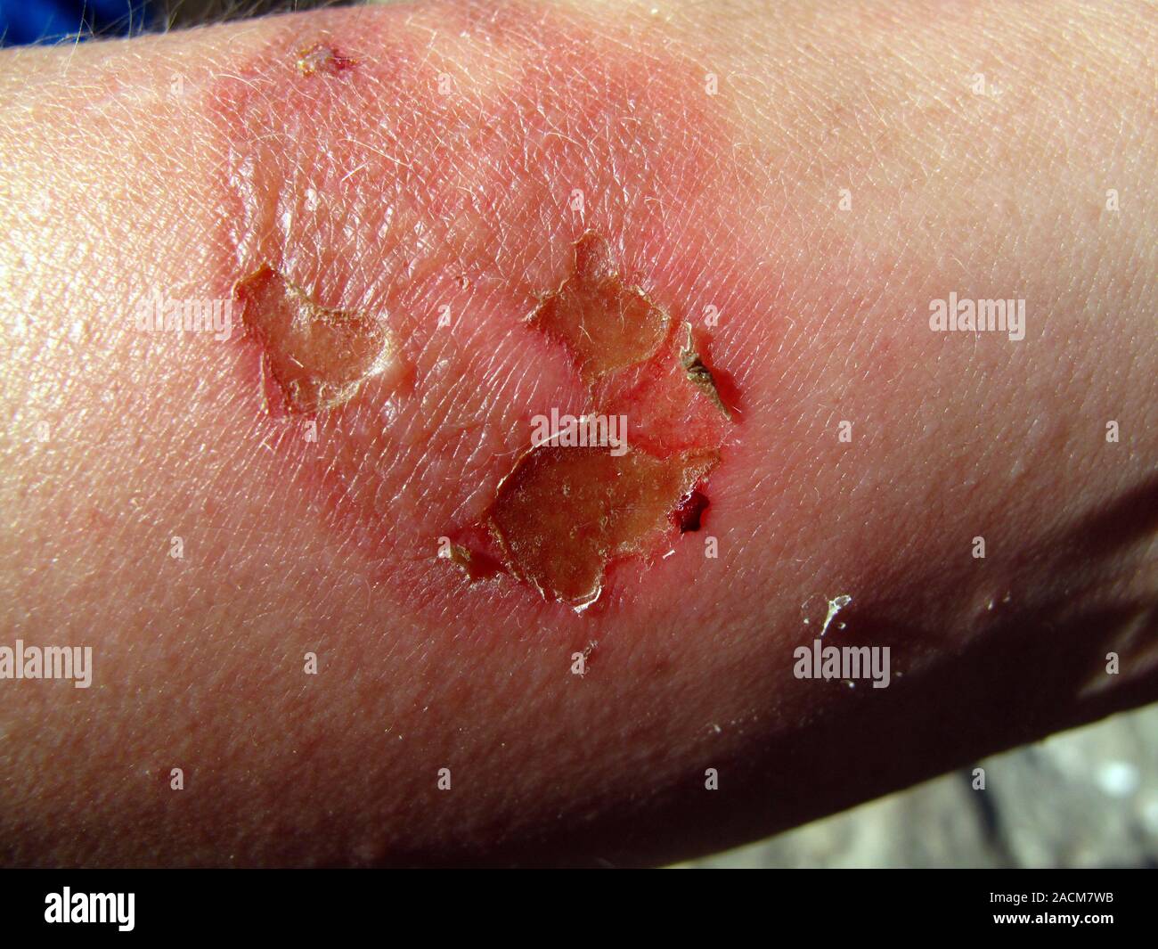 Scalded arm. Close-up of a second-degree burn to the skin of a person's ...