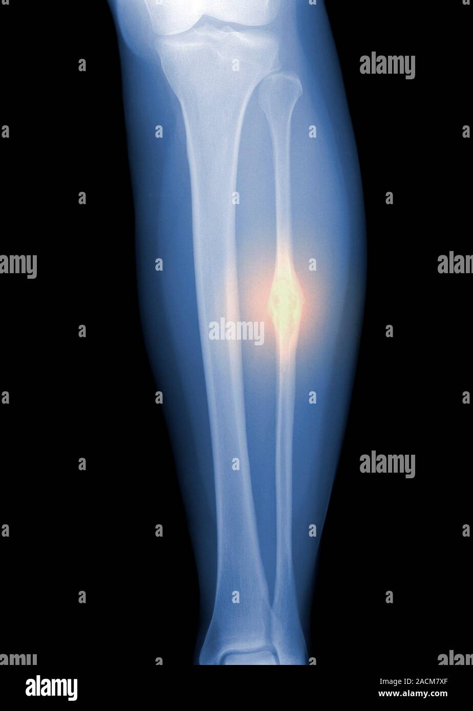 Bone cancer. Coloured X-ray of the leg of a 46 year old woman with a ...
