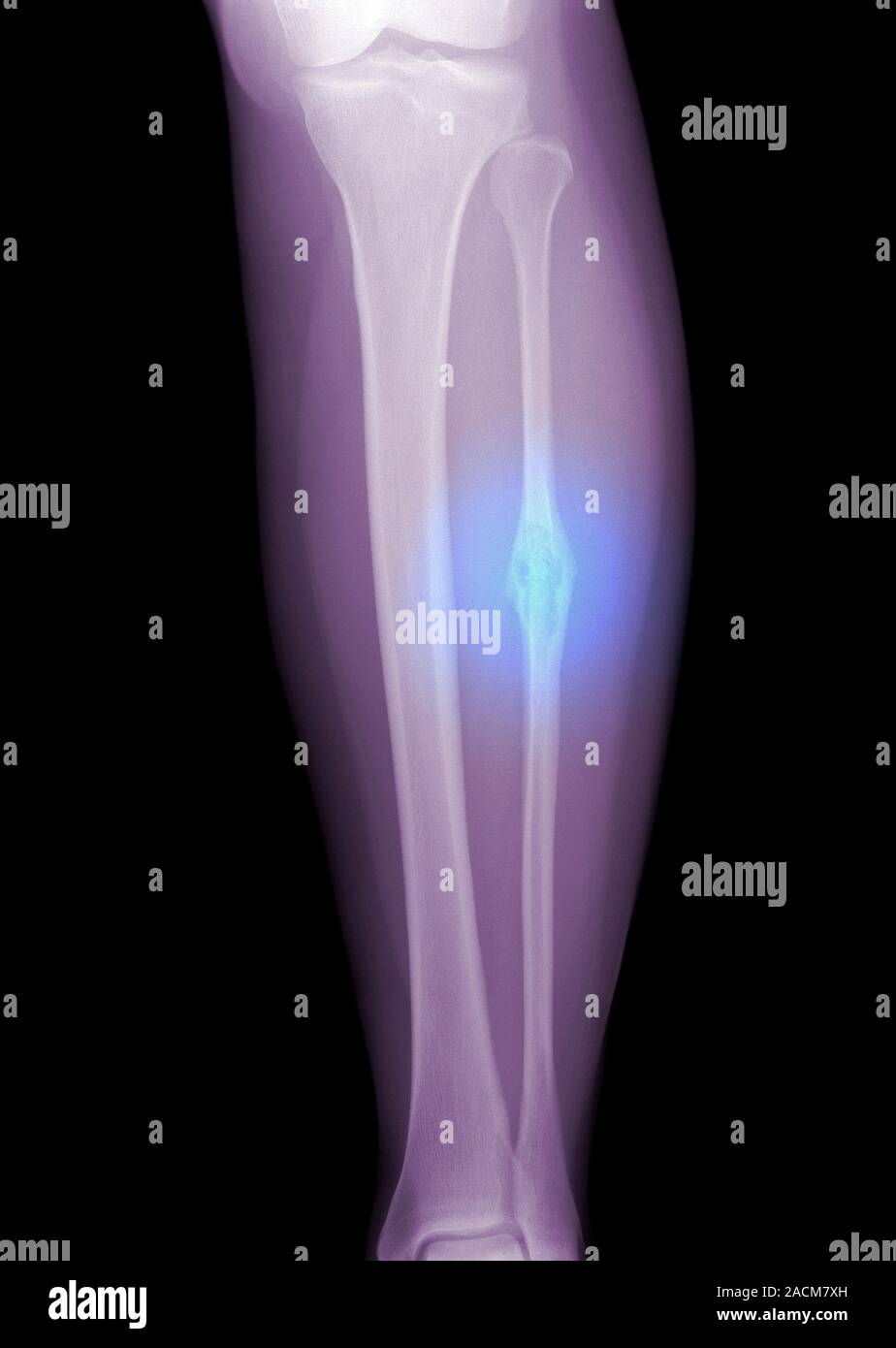 Bone cancer. Coloured X-ray of the leg of a 46 year old woman with a ...