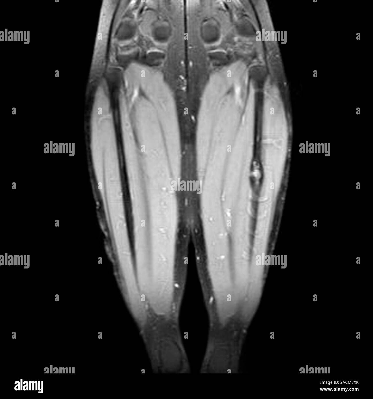 Bone cancer. Magnetic resonance imaging (MRI) scan of the legs of a 46 ...