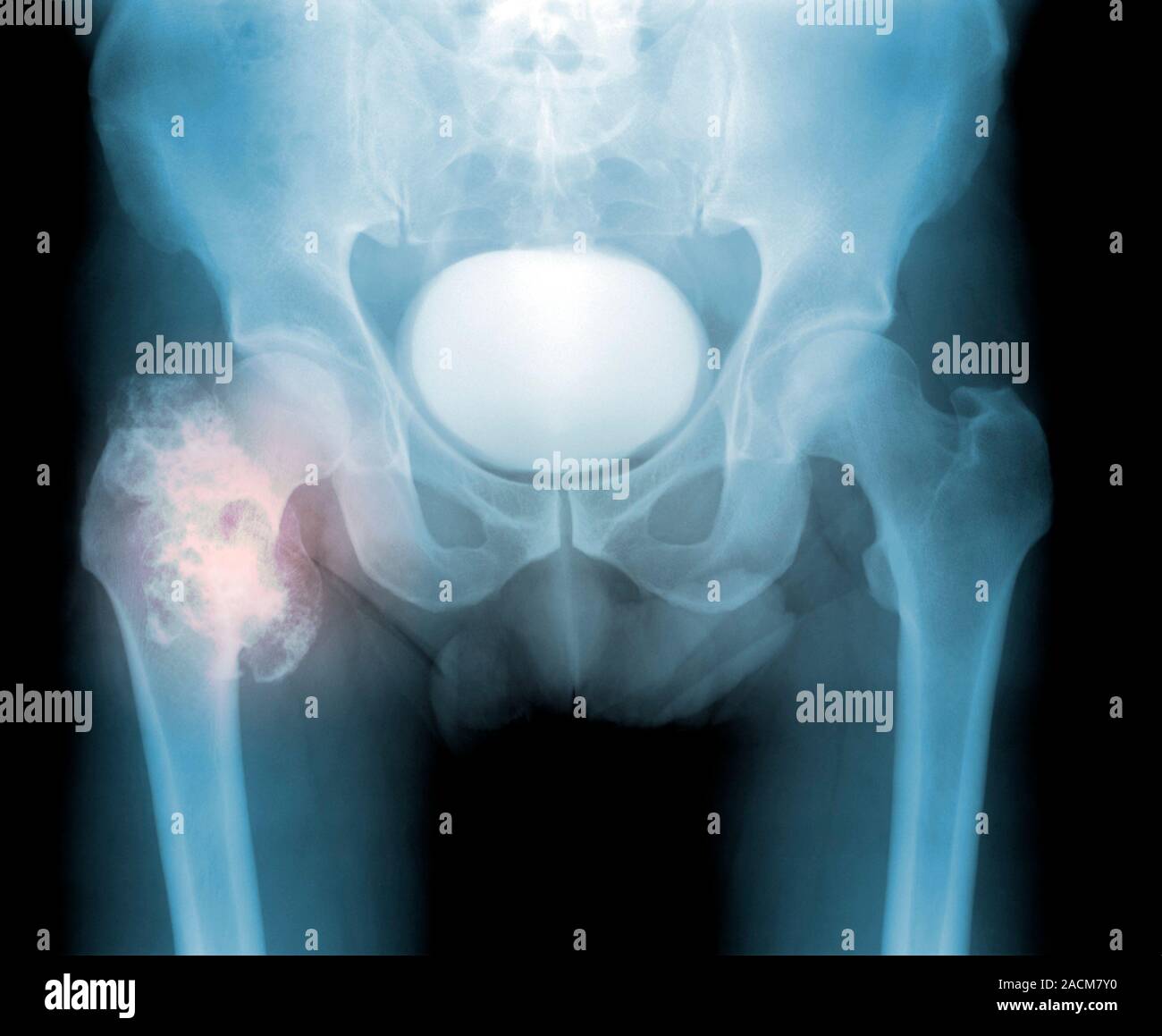 Bone cancer. Coloured X-ray of the pelvis of a 53 year old man with a ...