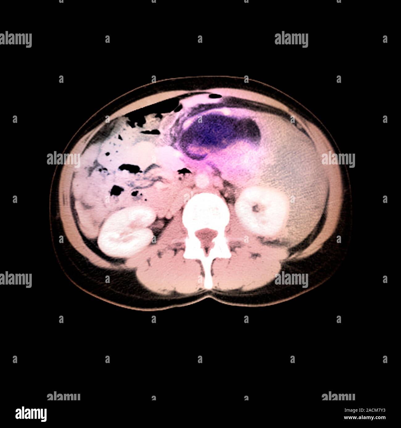 Liposarcoma cancer. Coloured magnetic resonance imaging (MRI) scan of ...