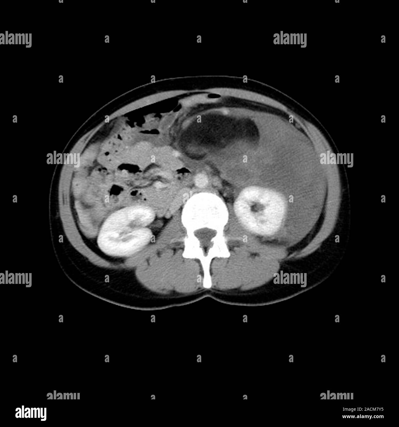 Liposarcoma cancer. Magnetic resonance imaging (MRI) scan of the ...