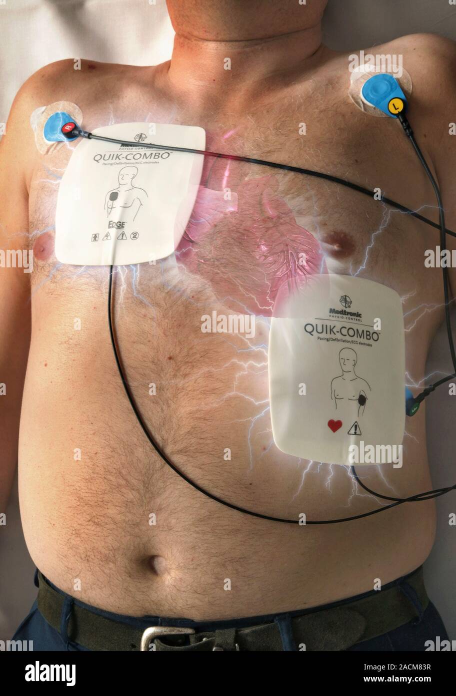 Conceptual image of a male heart attack (cardiac arrest) patient with ...