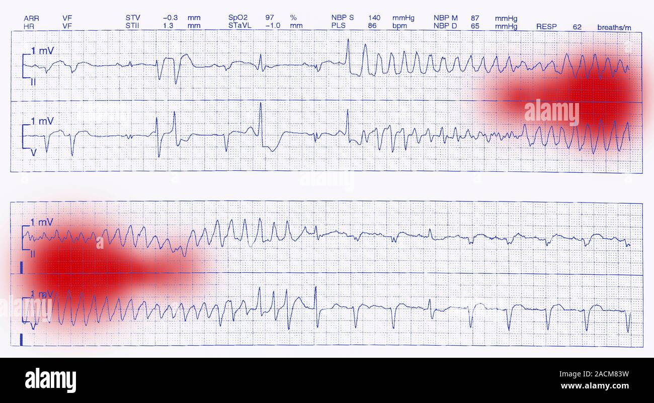 ECG (electrocardiogram) heart trace showing the irregular heartbeat of ...