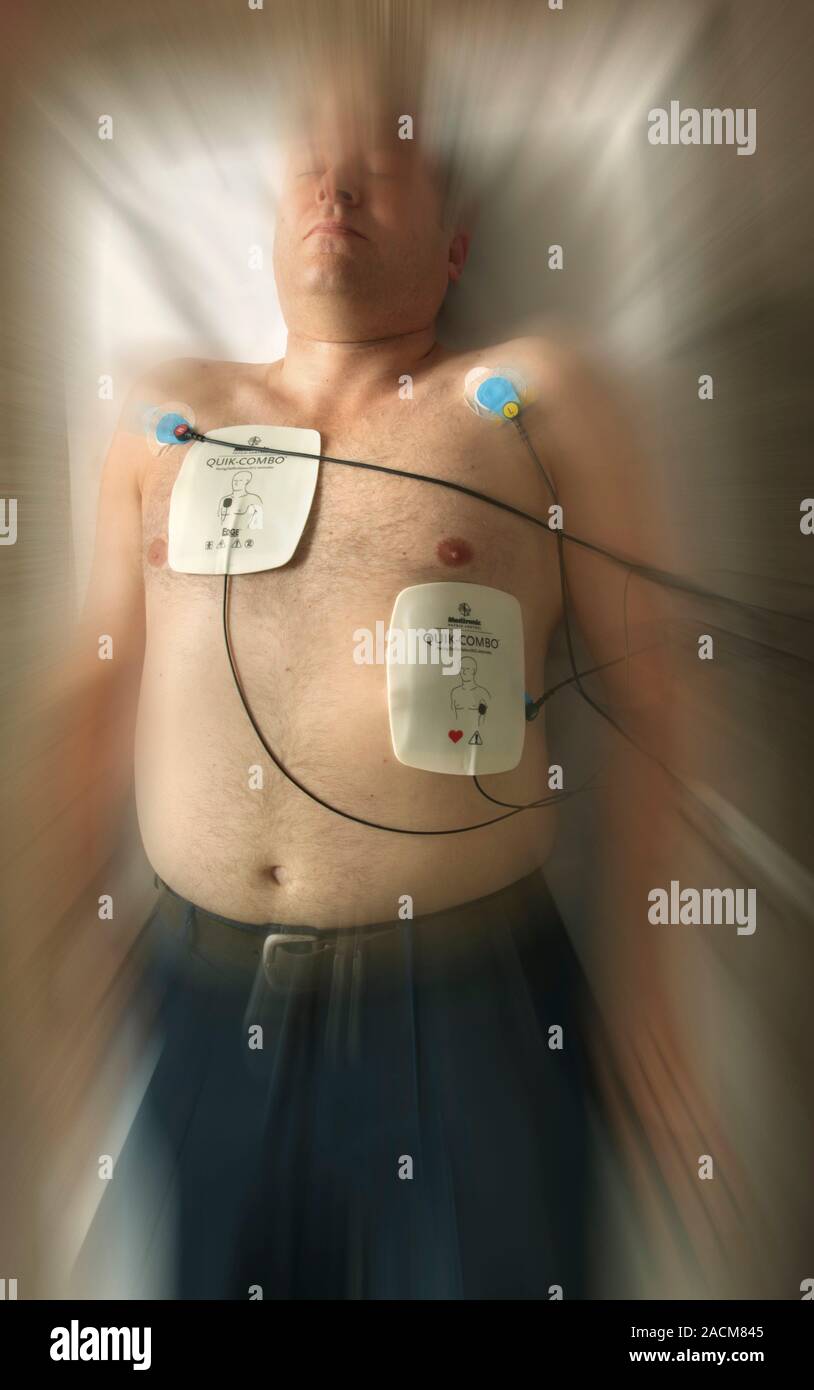 Male heart attack (cardiac arrest) patient lies on a trolley in an ...