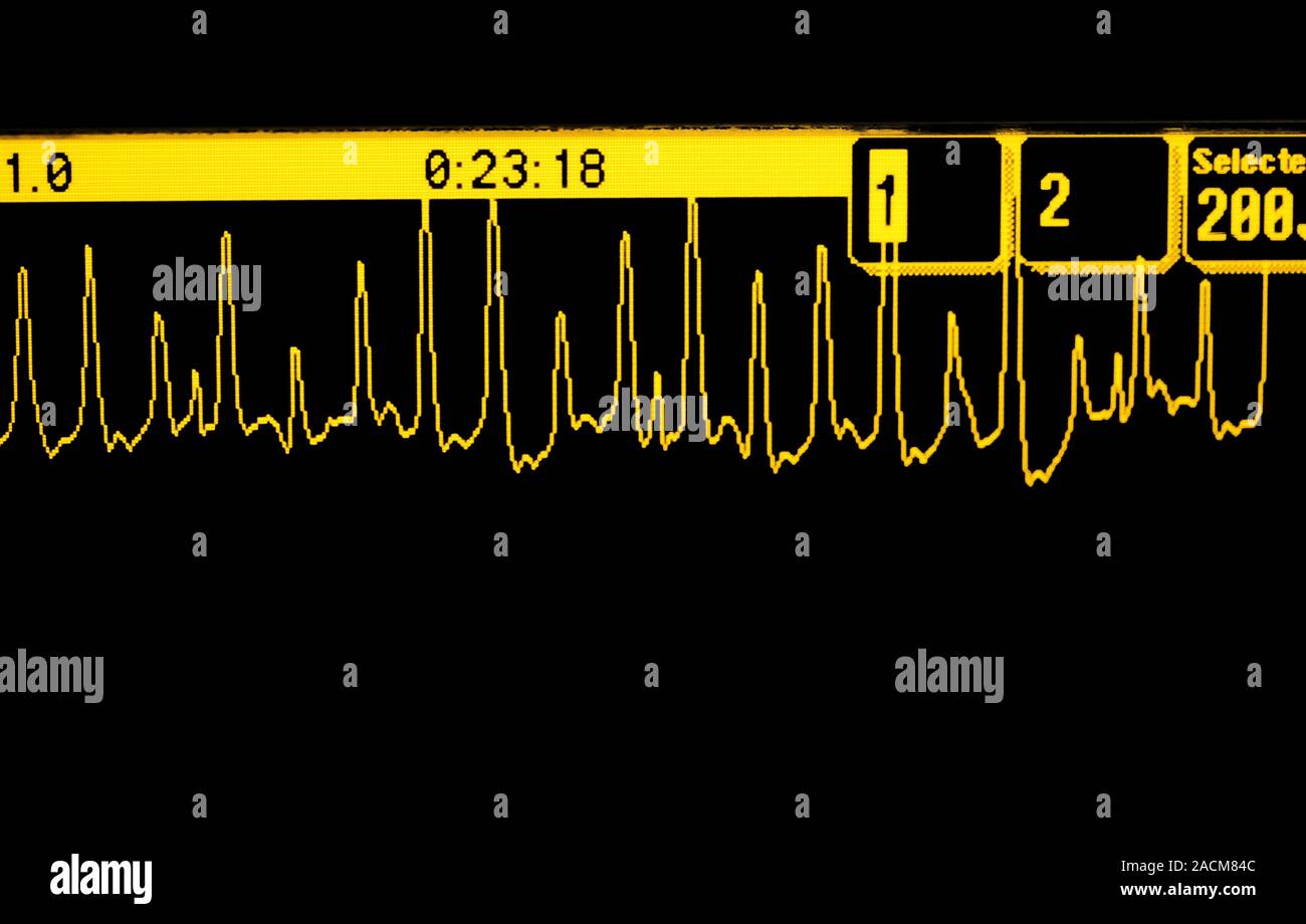 ECG (electrocardiogram) heart trace showing the irregular heartbeat of ...