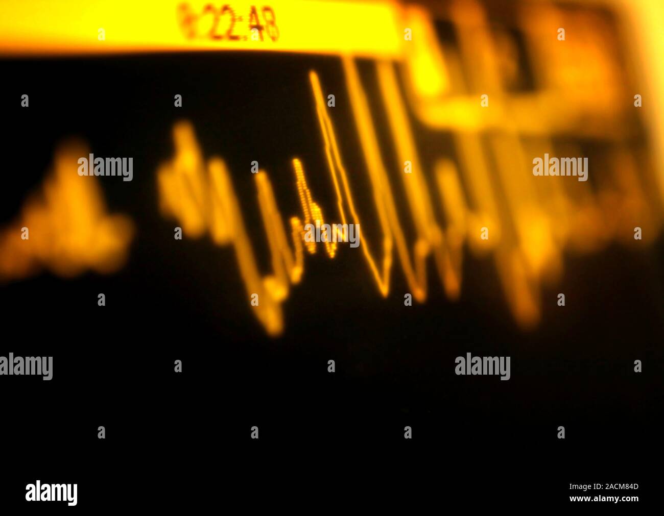 ECG (electrocardiogram) heart trace showing the irregular heartbeat of ...