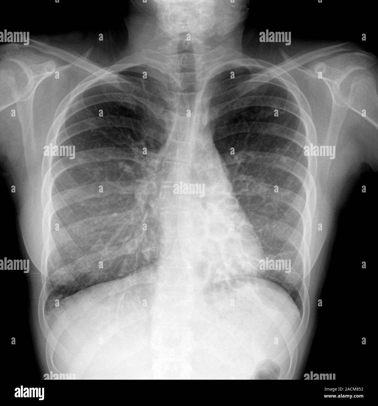 Chest X Ray Front View Showing Mucus In The Lungs In A 15 Year Old Female Patient With Cystic