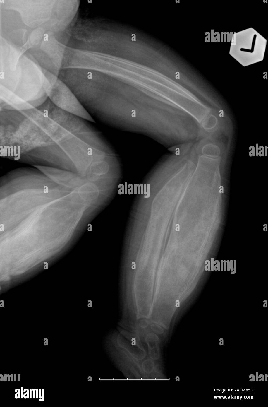 X-ray (side view) of the legs in an 11 month old infant with Caffey's ...