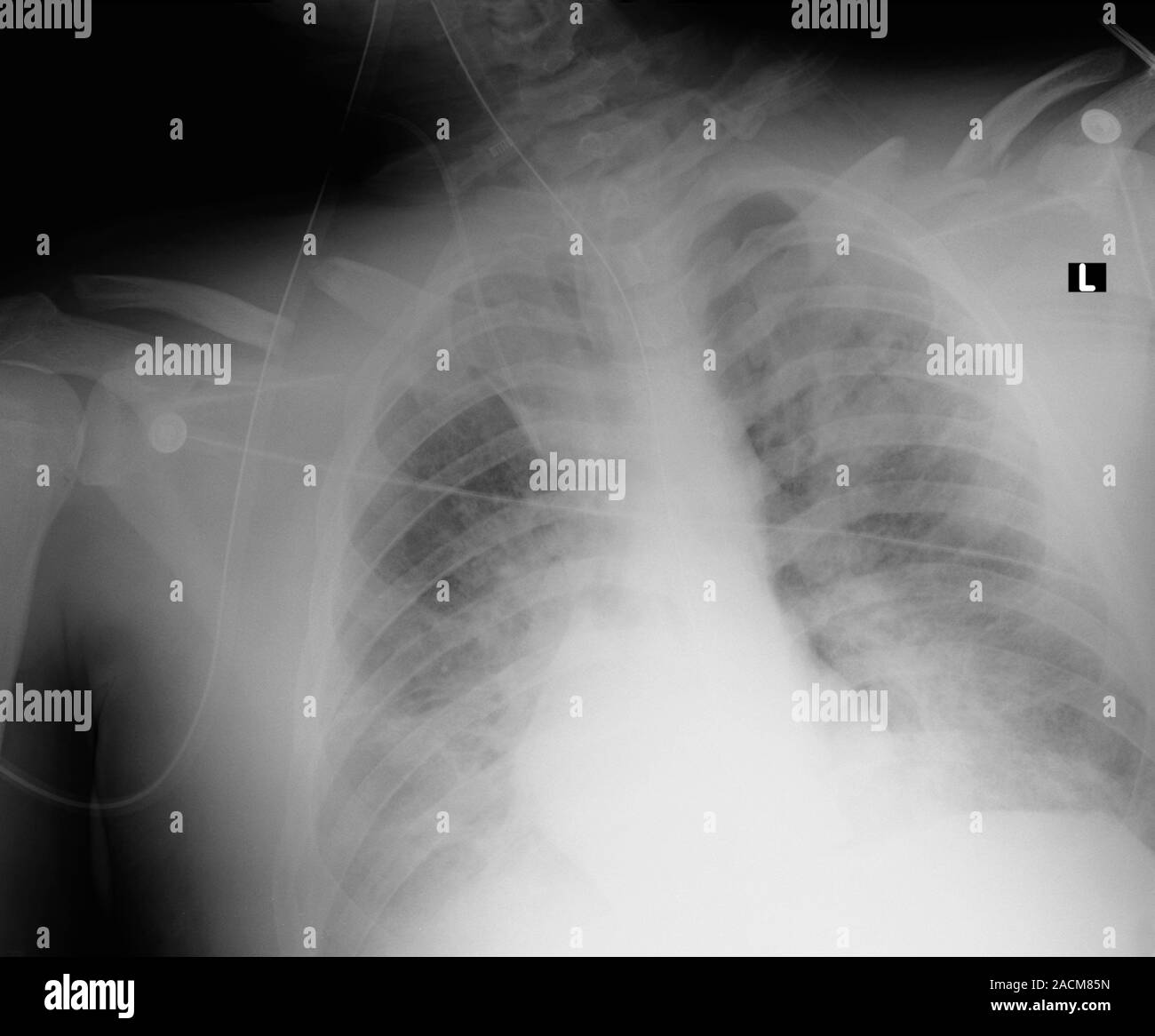 Chest X-ray (front view) showing widespread inflammation in the lungs ...