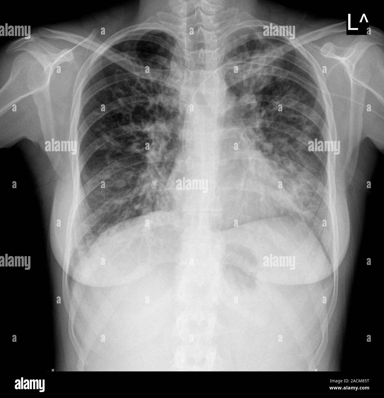 Chest X-ray (front view) showing mucus in the lungs in a 25 year old female patient with cystic ...