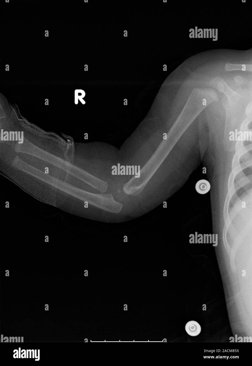 X-ray of the arm of a 5 month old female patient, a suspected child ...