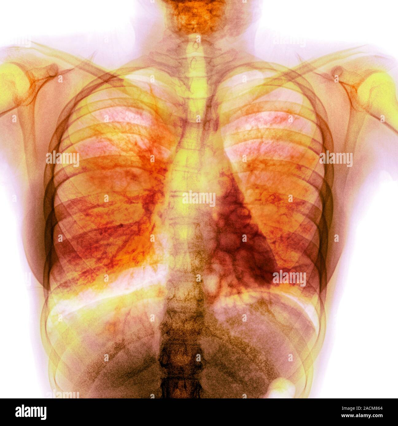 Coloured chest X-ray (front view) showing mucus in the lungs in a 15 ...