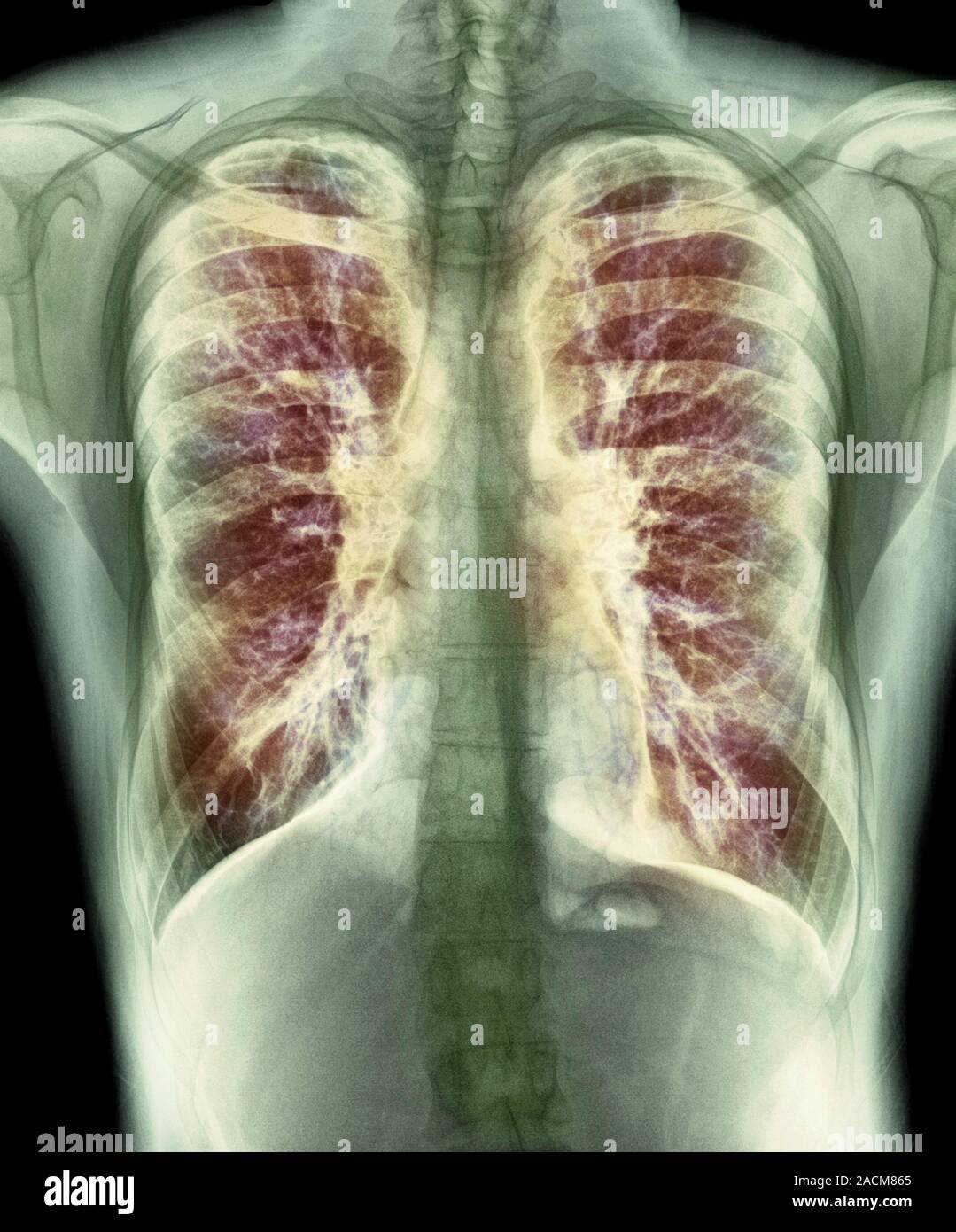 Coloured chest X-ray (front view) showing mucus in the lungs in a 28 ...