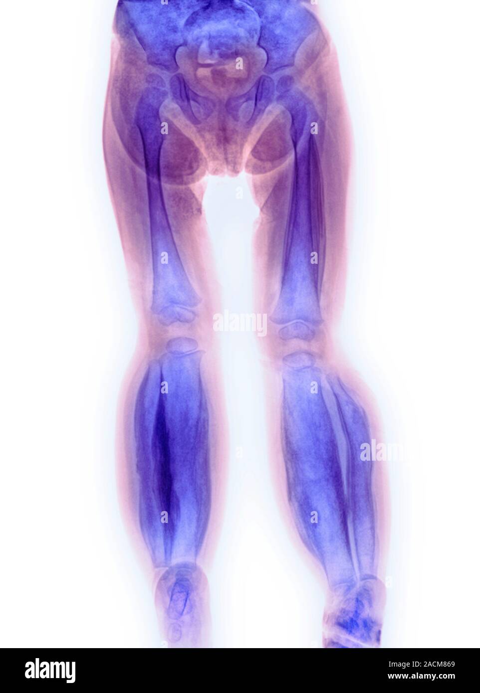 Coloured X-ray (posterior view) of the legs in an 11 month old infant ...