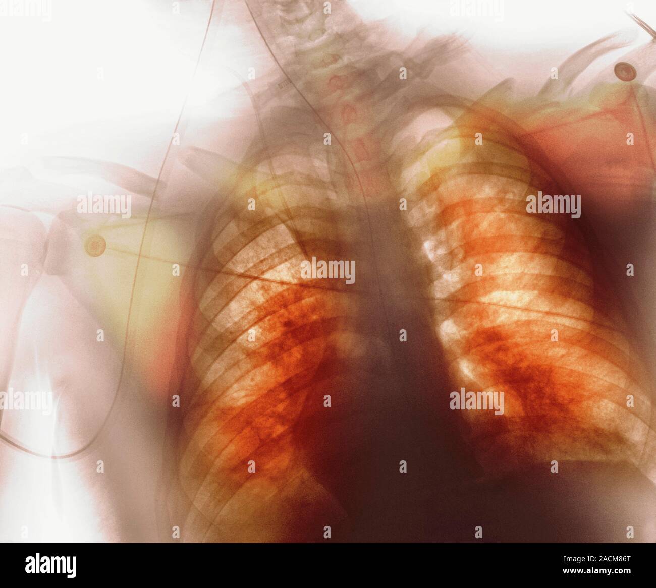 Coloured chest X-ray (front view) showing widespread inflammation in ...