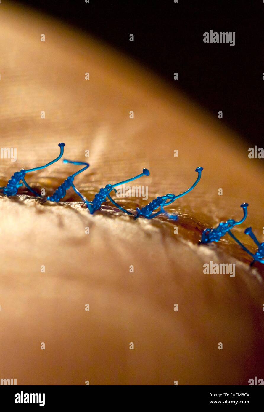 Surgical sutures. Close-up of sutures (stitches) in a patient's hand ...