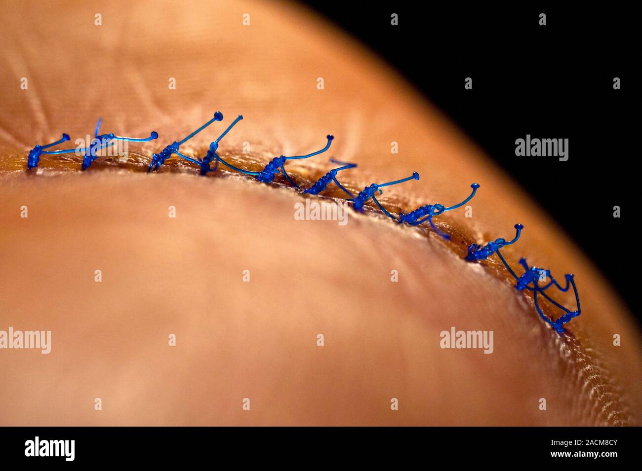 Surgical sutures. Close-up of sutures (stitches) in a patient's hand ...
