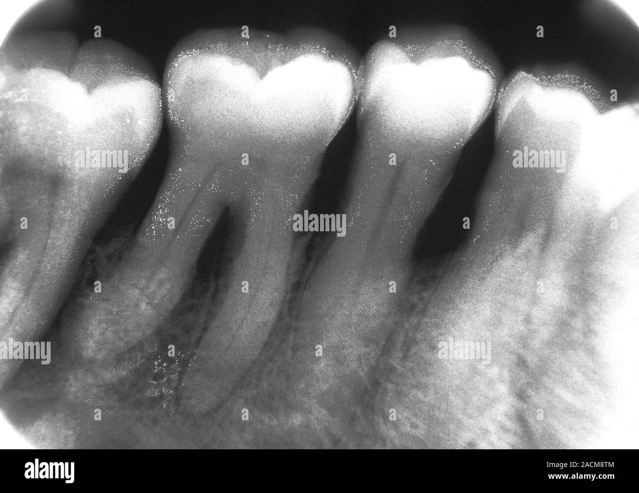 Periodontal disease. X-ray of the teeth of a patient with severe ...