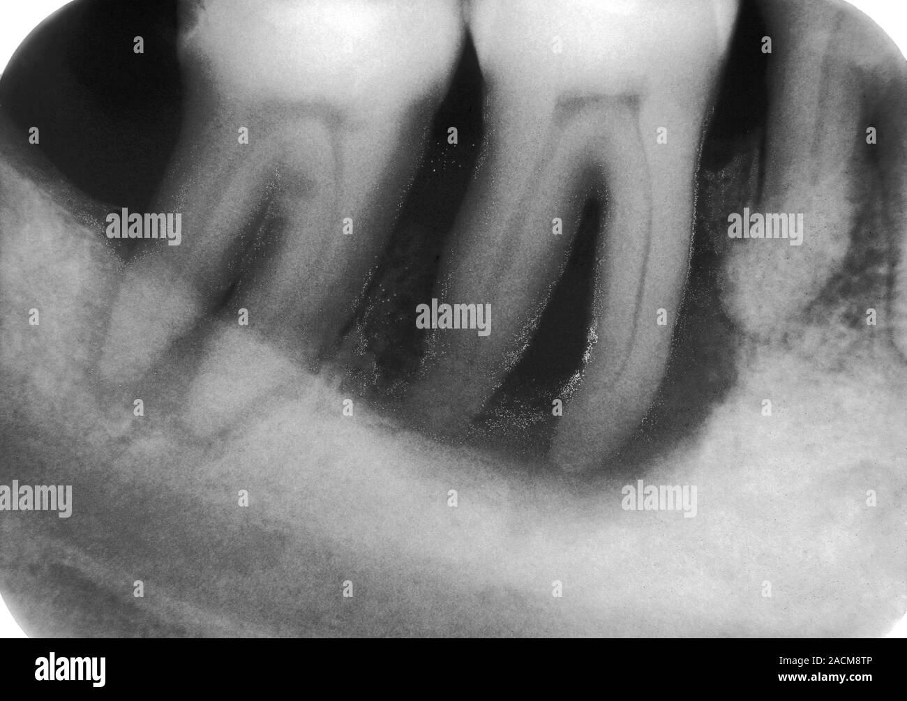 Periodontal disease. X-ray of the teeth of a patient with severe ...