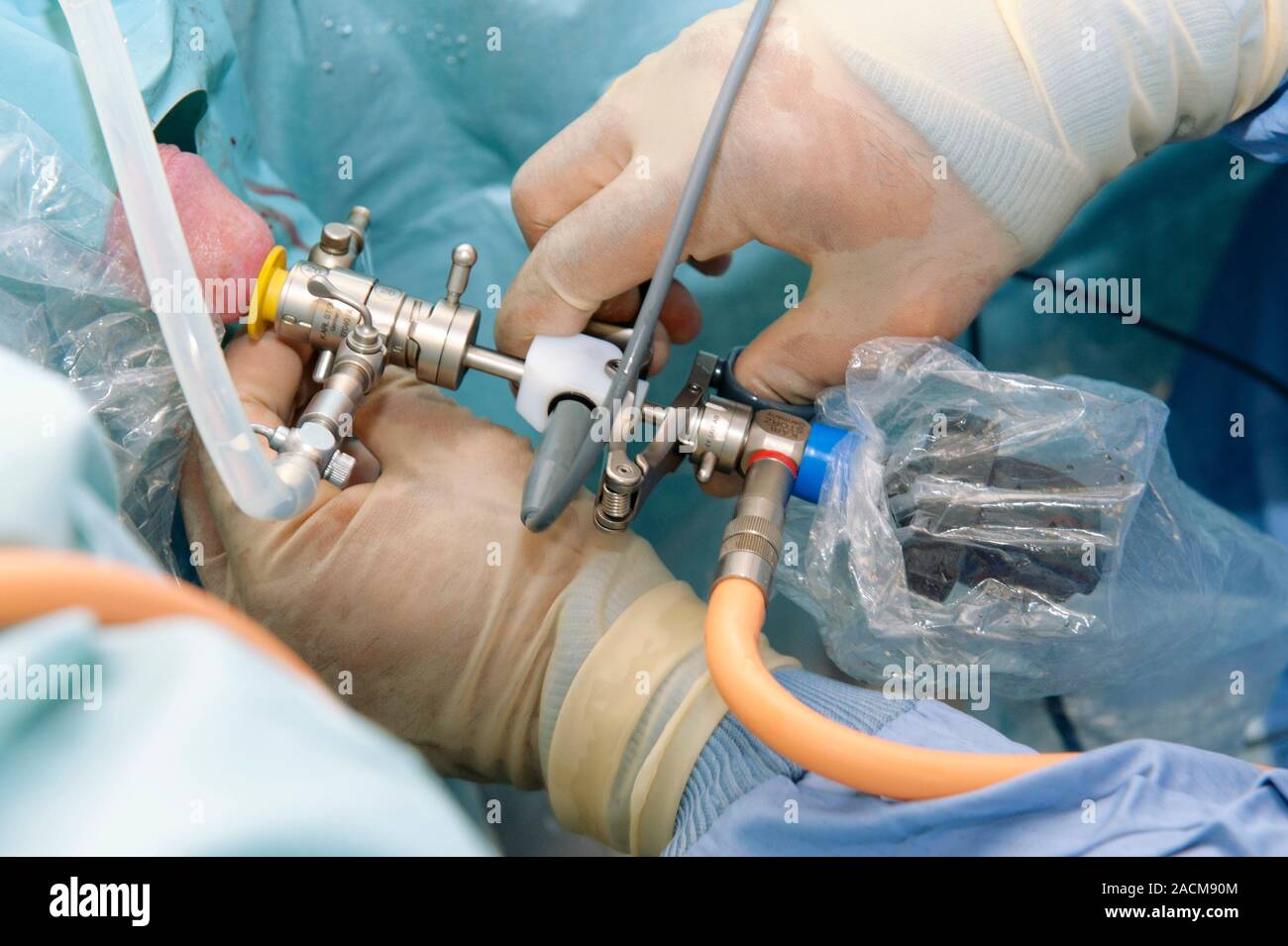 Bladder cancer surgery. Surgeon performing a transurethral resection of ...