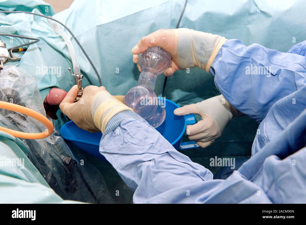 Bladder cancer surgery. Surgeon performing a transurethral resection of a bladder tumour (TURBT ...