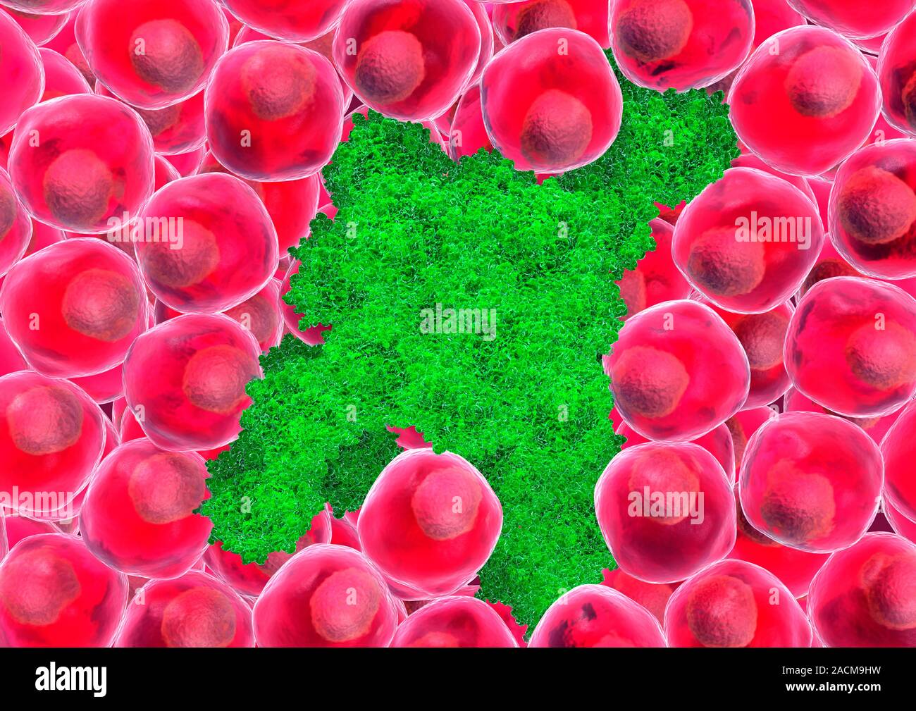 Cancer, conceptual image. Computer artwork of cancerous cells (green ...