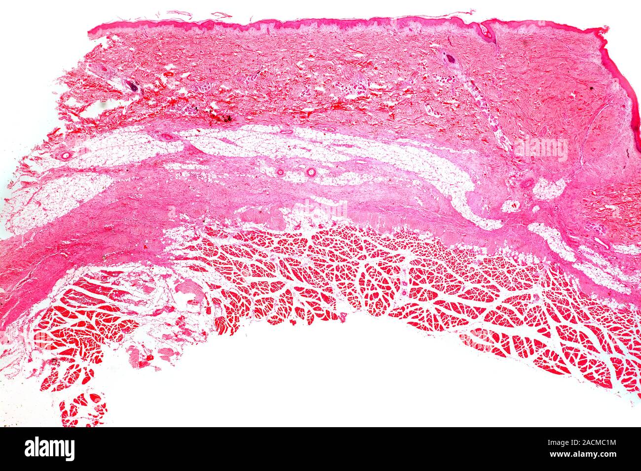 Surgical scar. Light micrograph showing a section through skin with a ...