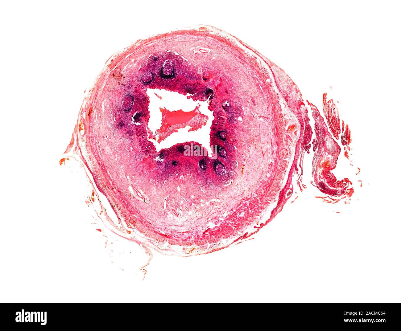 Acute appendicitis. Light micrograph of a section through an appendix ...
