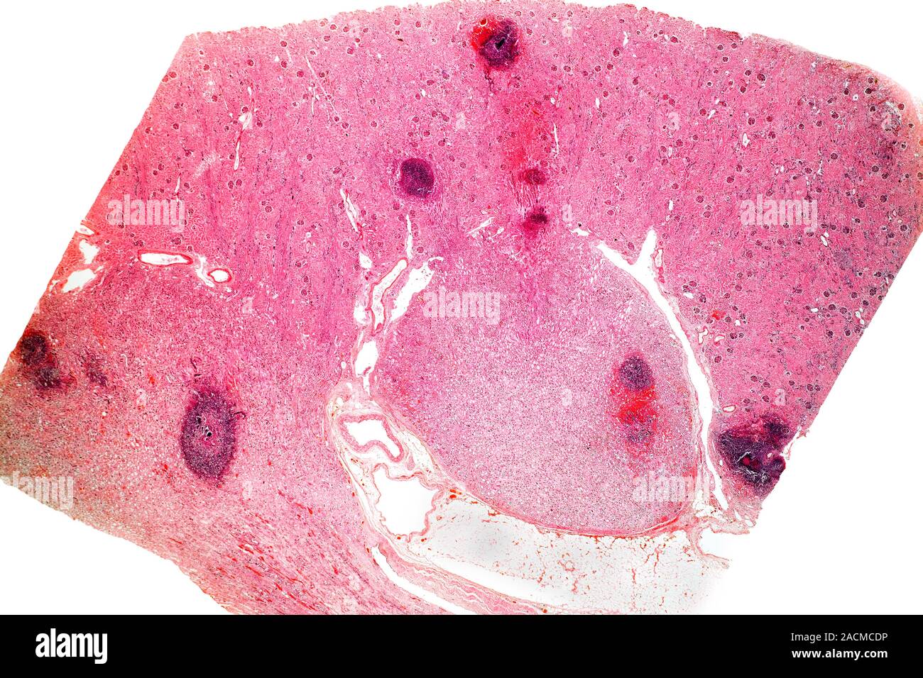 Kidney infection. Light micrograph of a section through a kidney with ...