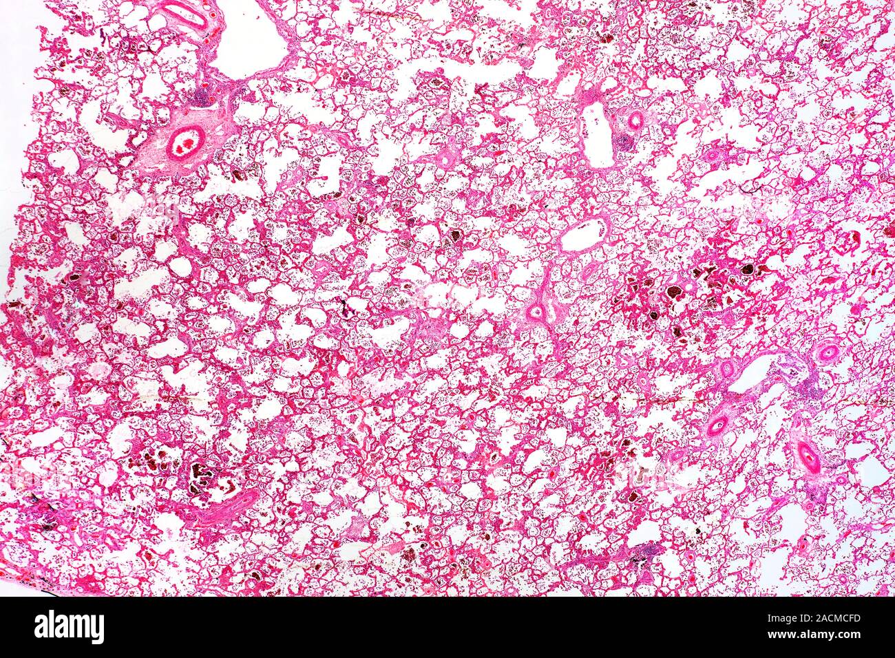 Diseased lung. Light micrograph micrograph of a section through a lung ...