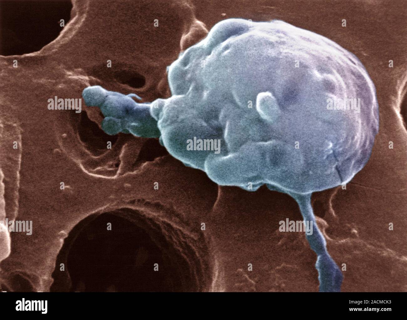 Cancer cell attacked by macrophages. Coloured scanning electron ...