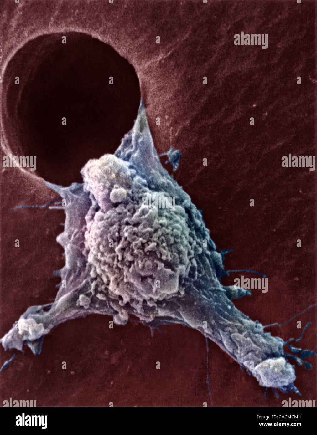 Migrating cancer cell. Coloured scanning electron micrograph (SEM) of a ...