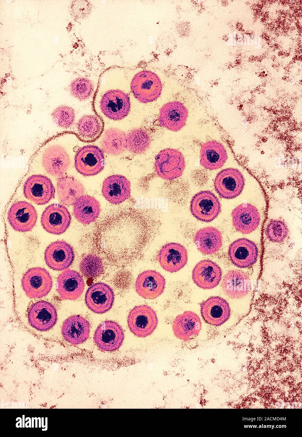 Herpes virus particles. Transmission electron micrograph (TEM) of a ...