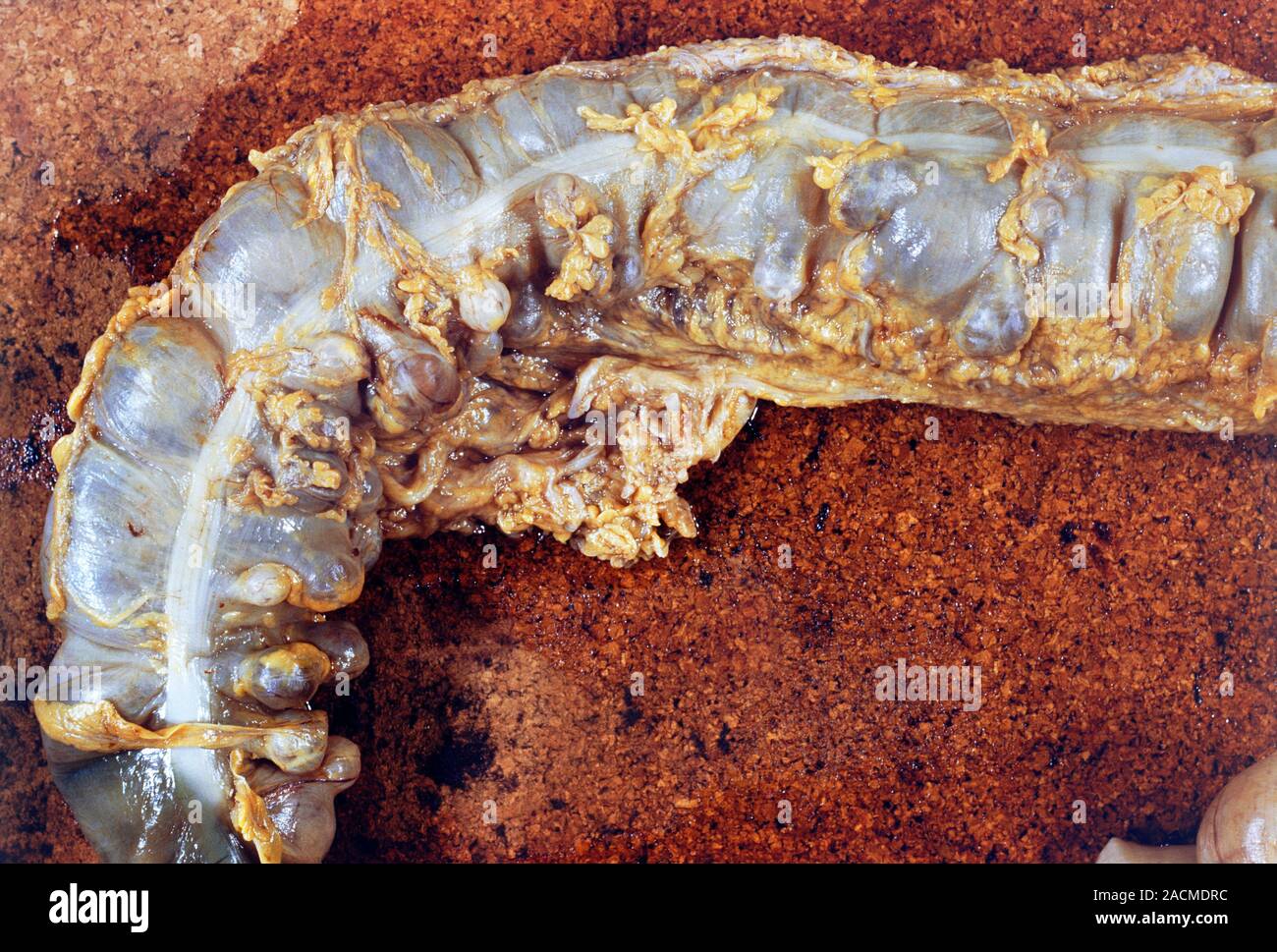 Diverticulosis. Gross specimen of a colon (large intestine) with ...